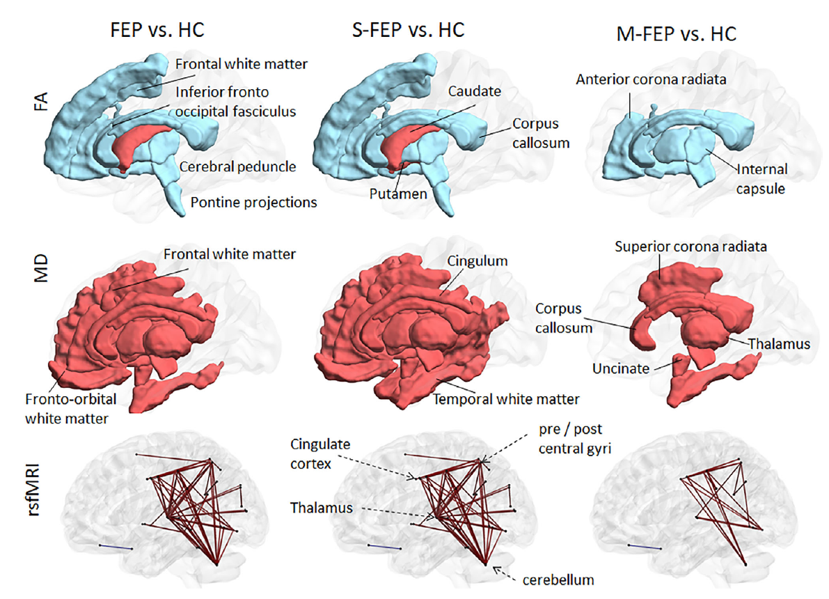 Multimodal MRI assessment for first episode psychosis- A major change in the thalamus and an ...